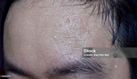 Excessive Sweating Or Hyperhidrosis And Oily Skin At Forehead Of Asian