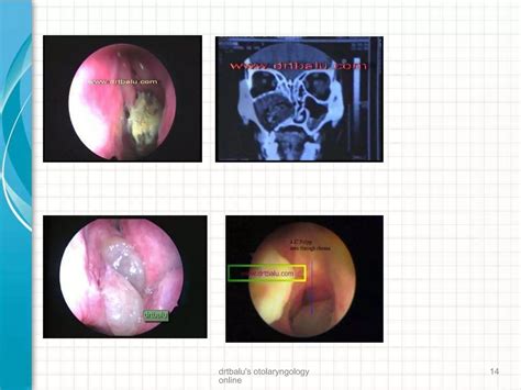 Nasal Polyps Etiologypathogenesisclinical Featuresmanagement Pptx