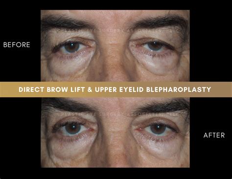 Corrective Plastic Surgery Photos Plastic Eye Surgery Associates