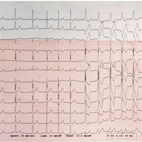 Atrial Tachycardiaatrial Flutter Being Unmasked By Adenosine The