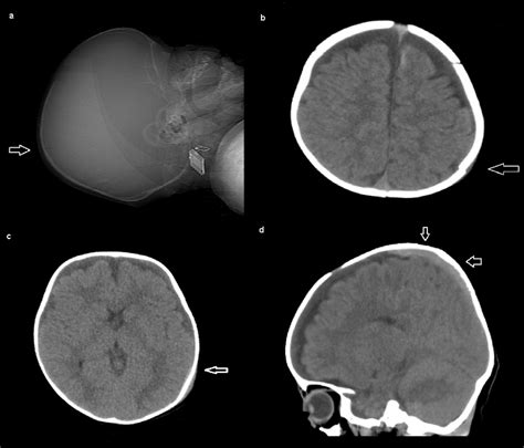 Right Temporal Linear Fracture Without Parenchymal Hemorrhage Diagnosis