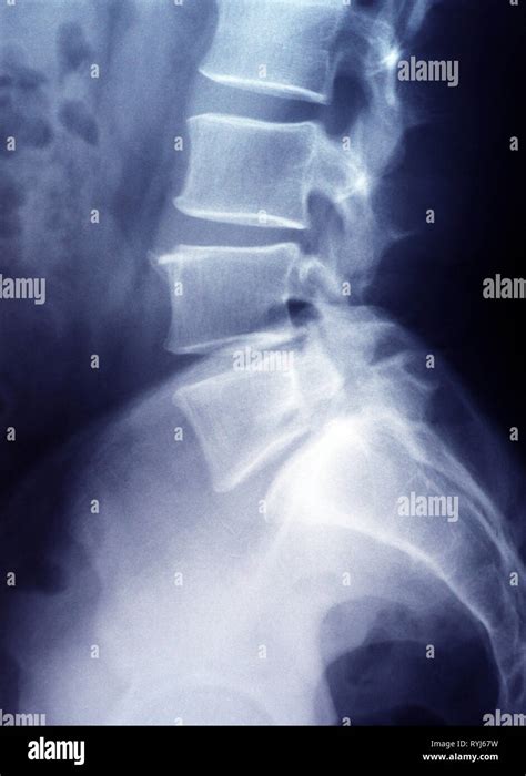 Lendenwirbelsäule Fotos und Bildmaterial in hoher Auflösung Alamy