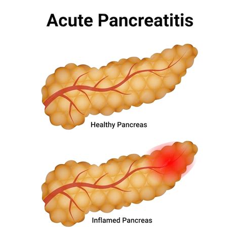 Acute Pancreatitis Healthy Pancreas Inflamed Pancreas Vector