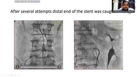 Stent Embolization Intervention Presentation Youtube