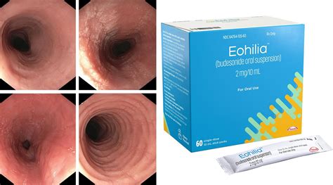 Fda Re Approves New Form Of 1997 Tx For Eoe Eohilia Anton Health