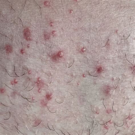 Mild Herpes Outbreak In Women Herpes Rash How To Tell It Apart From