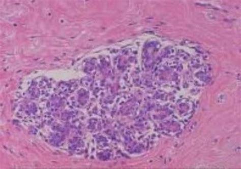 Novus Biologicals™ Human Breast Tissue Microarray Cancer Human Breast Cancer Metastasis Tissue