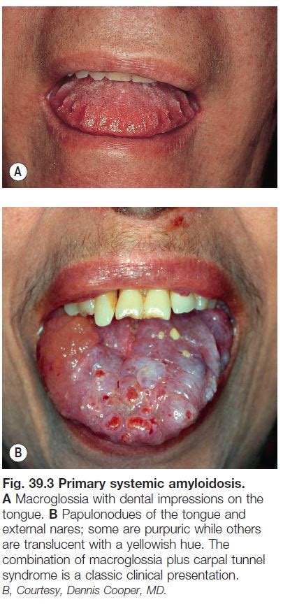 Primary Systemic Amyloidosis