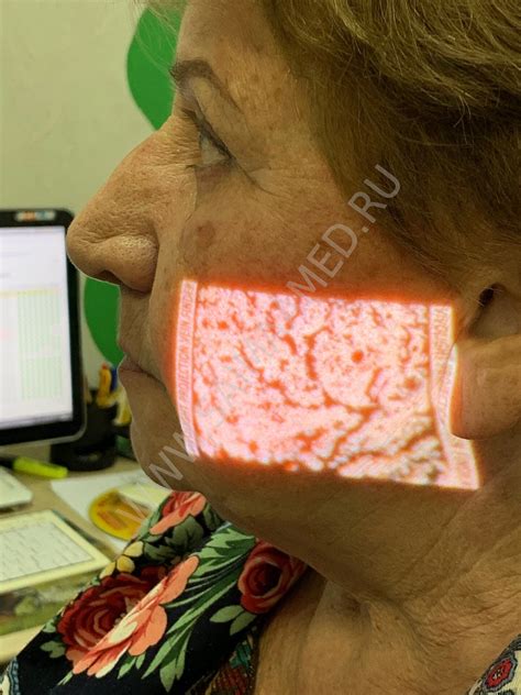 Прибор визуализации вен PROJECTION VEIN FINDER VIVO 500S(веновизор ...