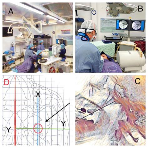 Juan Carlos Acevedo GonzÁlez On Linkedin Neurocirugia Neurosurgery Neuro Neuromodulation