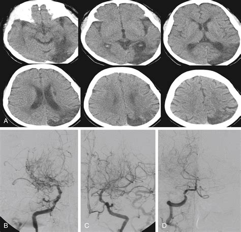 Posterior Cerebral Artery Disease Clinical Tree