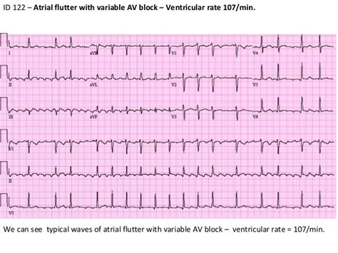 Icd 10 Code For Atrial Flutter Belnery