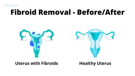 Fibroids Laparoscopic Myomectomy At Lois Lumpkin Blog