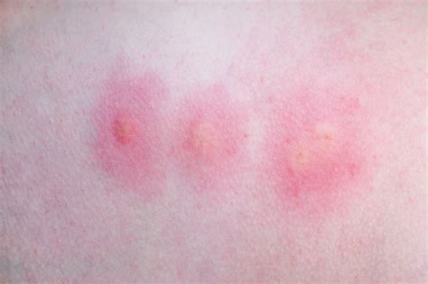 Identifying Bed Bug Bites Characteristics Reactions