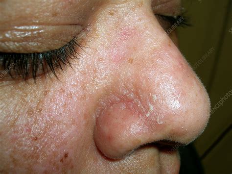 Seborrheic Dermatitis Under Eyes