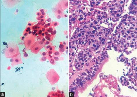 Role Of Bronchoscopic Cytology In Diagnosis Of Pulmonary Lesions Pmc