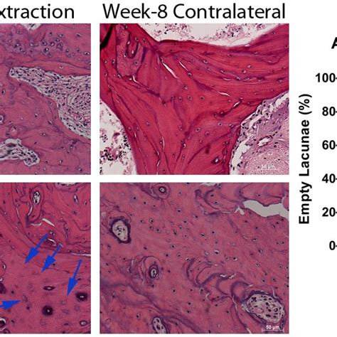 Analysis Of Alveolar Bone At The Extraction Site Excluding Any