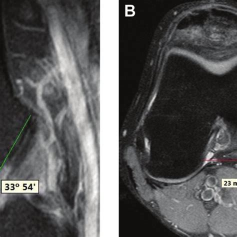 Pdf The Importance Of The Intercondylar Notch In Anterior Cruciate