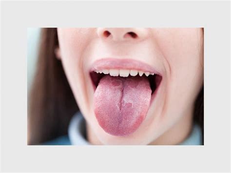 The Warning Signs Of Tongue Cancer Randfontein Herald