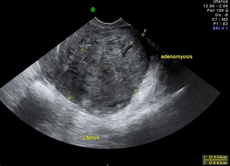 Chapter 4 Adenomyosis Melaka Fertility