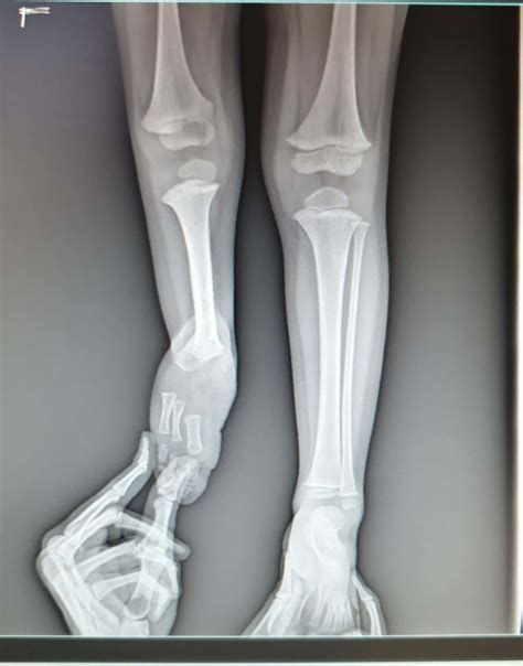 Congenital Lower Limb Deformity The Royal Specialist Hospital