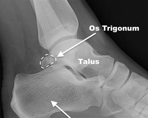 Os Trigonumos Trigonum Syndrome Humboldt Foot And Ankle