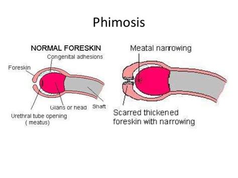 Is Phimosis Really That Bad Five Levels Of Phimosis Severity Qrjmn