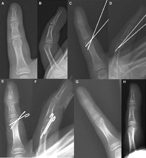 Frontiers Clinical Outcomes Of Closed Displaced Phalangeal Neck