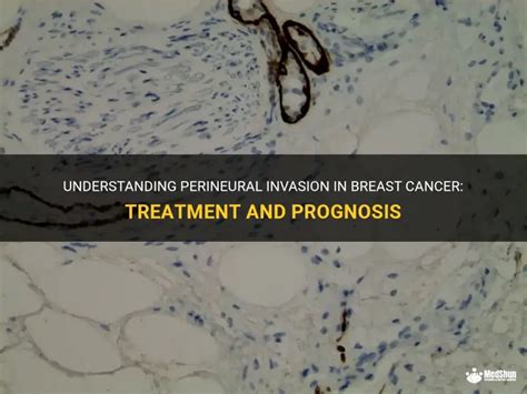 Understanding Perineural Invasion In Breast Cancer Treatment And