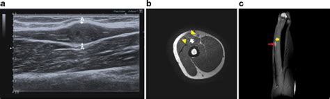 A Grey Scale Image Showing Characteristic Fusiform Swelling In