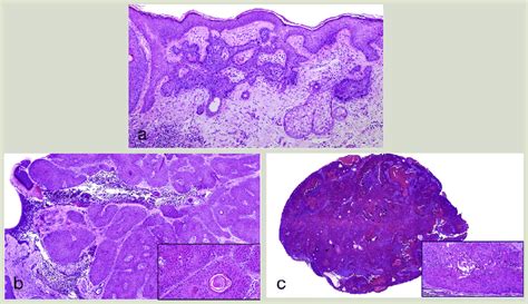 A Tumour Of The Follicular Infundibulum Anastomosing Epithelial Download Scientific Diagram