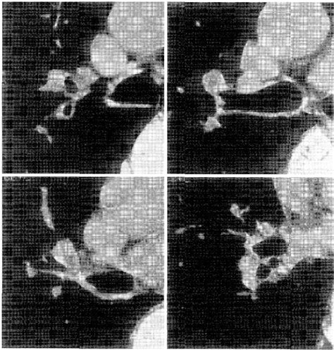 Figure 1 From A Case Of Mucosal Spreading Hilar Adenocarcinoma Of The