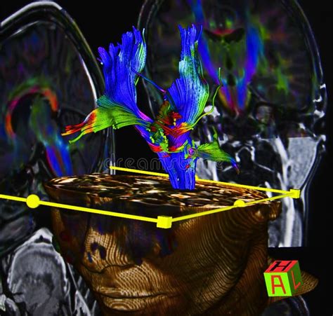 Brain Diffusion Tensor MR Imaging Stock Photo Image Of Exam Scan 33304942