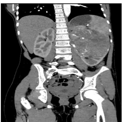 Gross Specimen After Radical Nephrectomy Download Scientific Diagram