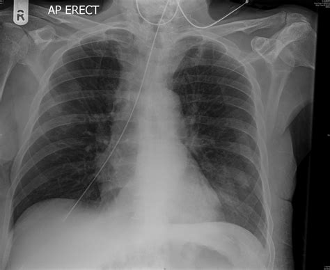 Nasogastric Tube Check Easy Or Not Bmj Case Reports