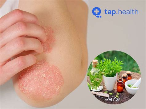 15 Effective Homeopathic Remedies For Eczema Natural Relief