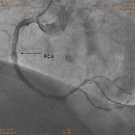 Acute Stemi In The Setting Of A Single Coronary Artery Anomaly Bmj
