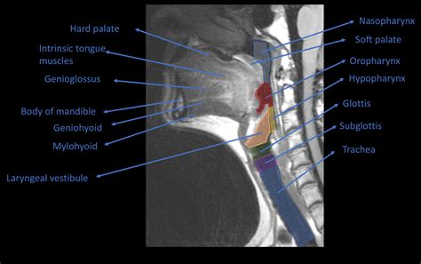 Hypopharynx Anatomy Ct Scan