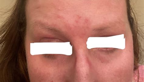 Rash Between Eyebrows R Dermatologyquestions