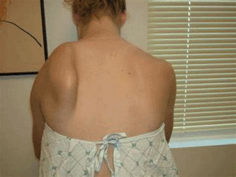 Scapulothoracic Dysfunction Burners Stingers Thoracic Outlet Syndrome And Miscellaneous