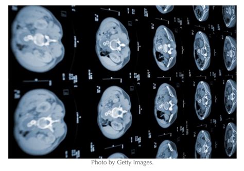 Rsna Margulis Award Honors Ai Tool For Pancreatic Cancer Detection Applied Radiology