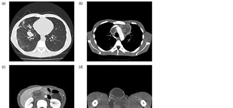 A Multiple Lung Metastases B Mediastinal Lymph Node Metastasis Download Scientific