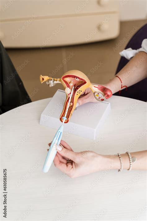 Iud Insertion Steps