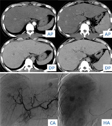 A Dynamic Liver Computed Tomography The Liver Exhibits Surface Download Scientific Diagram