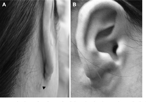 Figure 3 From Postauricular Flap Based On Dermal Pedicle For Reconstruction Of Congenital