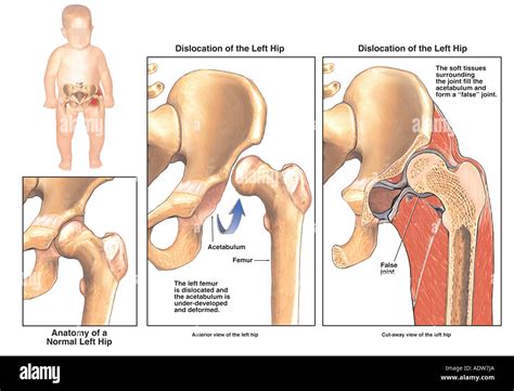 Congenital Hip Dysplasia