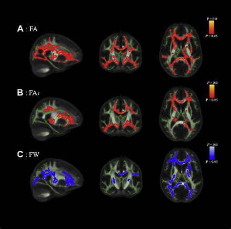 Voxelwise Group Comparison Between Patients With Obsessive Download
