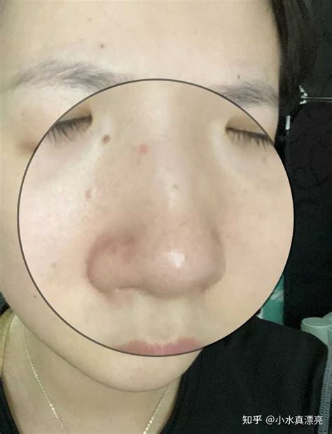 脸上黑头粉刺多，该如何祛除？ 知乎