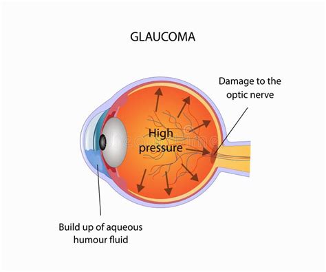 Glaucoma Eye Diagram Glaucoma Anatomy Stock Illustrations 777