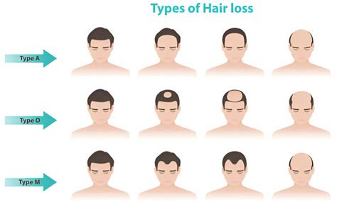 Androgenetic Alopecia Causes